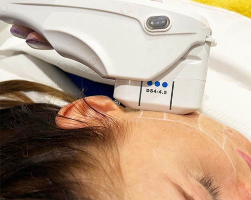 HIFU Facelift & Body Tightening - VIVO Body Studio
